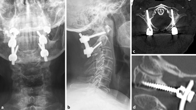 Dorsale Stabilisation der Halswirbelkörper HWK1/HWK2 modifiziert nach ...