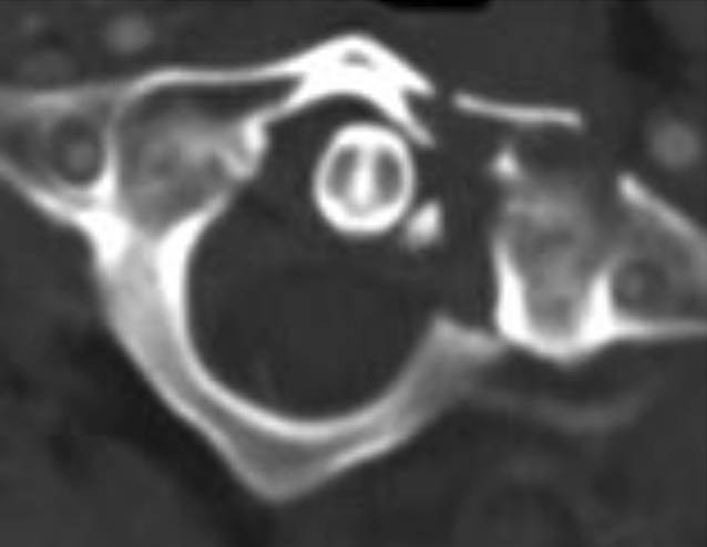 Dorsale Stabilisation der Halswirbelkörper HWK1/HWK2 modifiziert nach ...