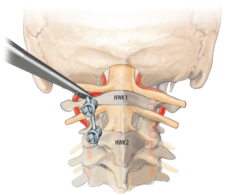 Dorsale Stabilisation der Halswirbelkörper HWK1/HWK2 modifiziert nach ...