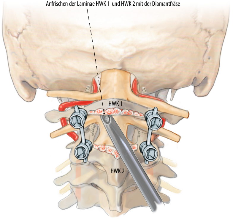 Dorsale Stabilisation der Halswirbelkörper HWK1/HWK2 modifiziert nach Goel-Harms mit HWK-1 ...
