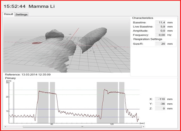 Deep inspiration breath-hold (DIBH) radiotherapy in left-sided breast ...
