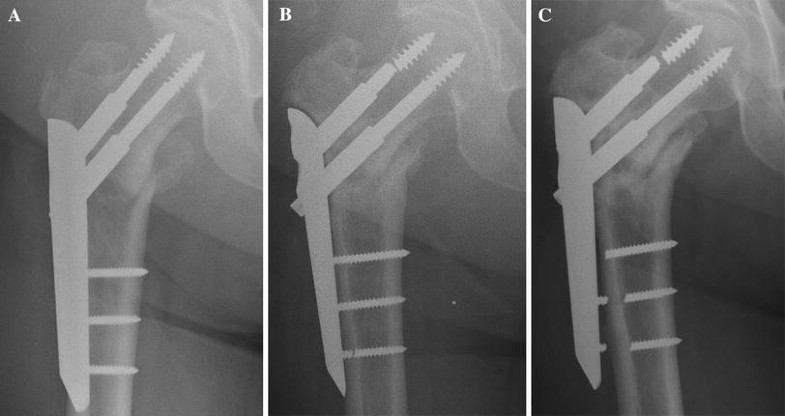 A comparative study between gamma nail and percutaneous compression ...
