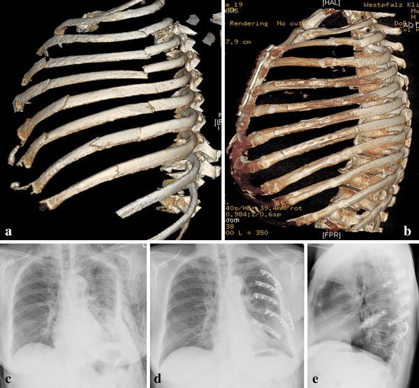 Severe trauma of the chest wall: surgical rib stabilisation versus non ...