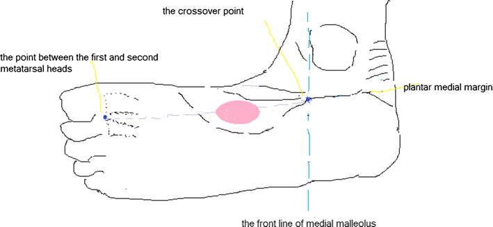 Medial plantar flap to repair defects of palm volar skin | SpringerLink