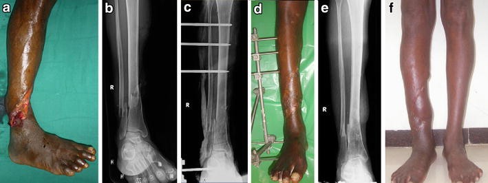 Ganga hospital open injury score in management of open injuries ...