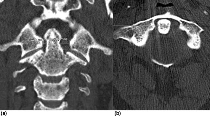 It is the lateral head tilt, not head rotation, causing an asymmetry of ...