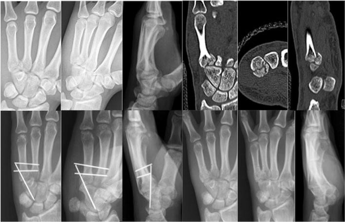 Management algorithm for index through small finger carpometacarpal ...