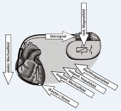 Perioperatives Management von Patienten mit implantiertem Schrittmacher ...