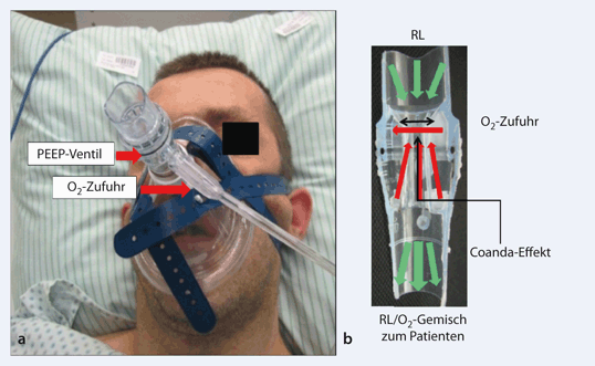 EzPAP® zur Therapie der postoperativen Hypoxämie im Aufwachraum ...