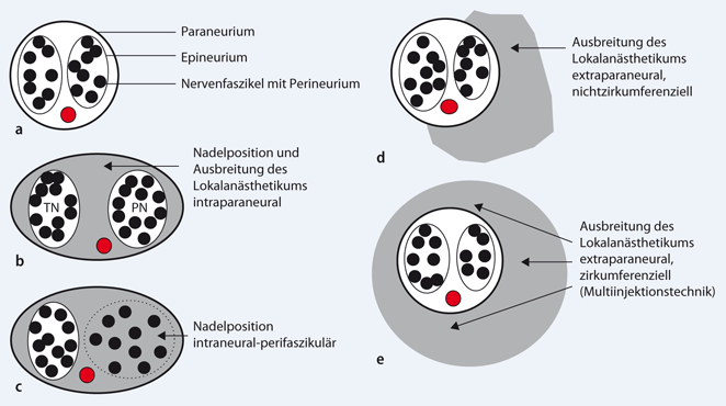 Distale Blockaden des N. ischiadicus | SpringerLink