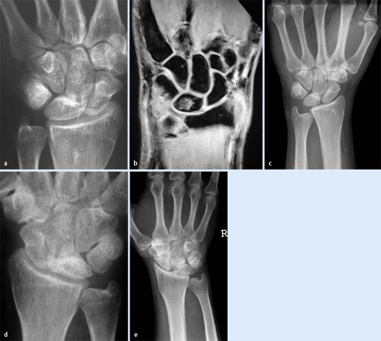 Morbus Kienböck | SpringerLink