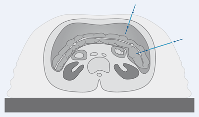 Adipositas – chirurgische Therapieprinzipen | SpringerLink