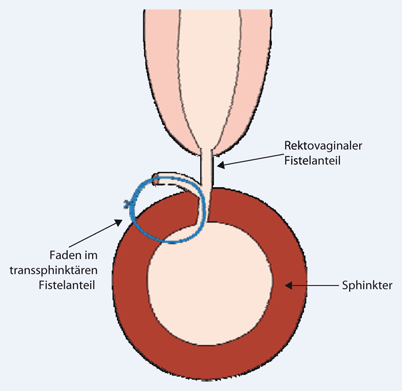 Perianale Crohn-Fisteln | SpringerLink