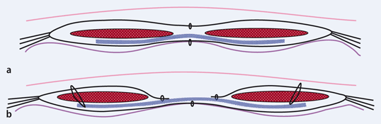Narbenhernie – Wie ist zu verfahren? | SpringerLink