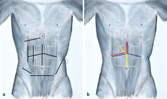 Abdominelle Zugänge und Bauchdeckenverschluss | SpringerLink
