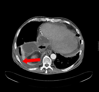 Biliodigestive Anastomosen | SpringerLink