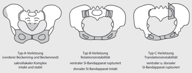 Aktuelle Behandlung der Beckenringfraktur | SpringerLink