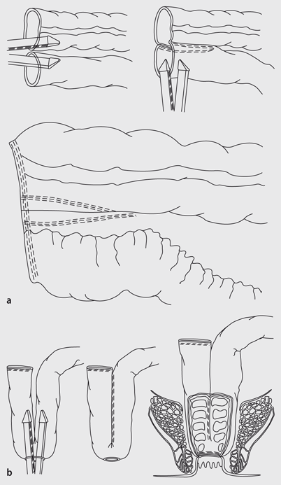 Anastomosentechniken am GastrointestinaItrakt | SpringerLink