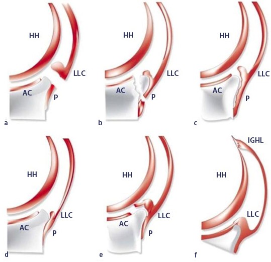 Schulterluxation bei Sportlern | SpringerLink