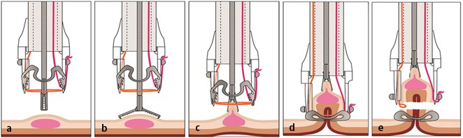 Full-Thickness-Resection-Device (FTRD) | SpringerLink