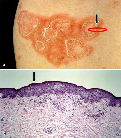 Von der Hautbiopsie zur Diagnose | SpringerLink