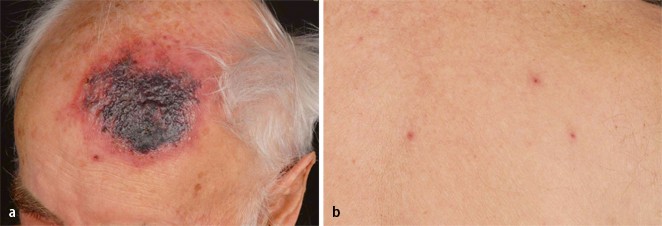 Hautinfektionen nach Transplantation | SpringerLink