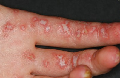Lupus erythematodes | SpringerLink