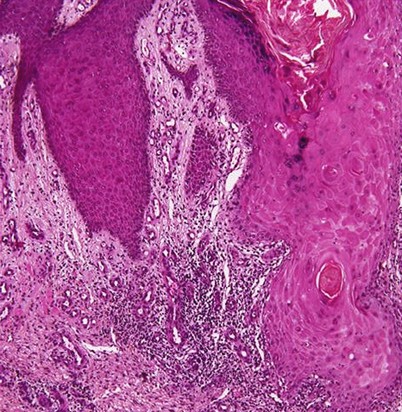 Verruköses spinozelluläres Karzinom auf Lichen ruber hypertrophicus ...