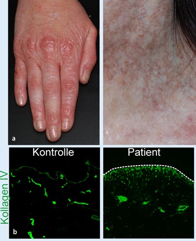 Epidermolysis bullosa | SpringerLink