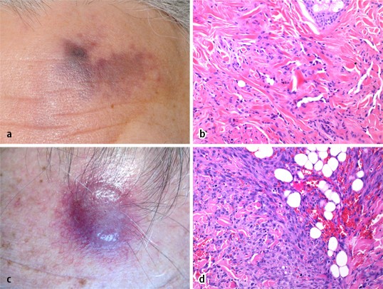 Tumoren der Kopfhaut | SpringerLink