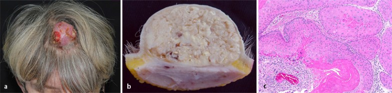 Tumoren der Kopfhaut | SpringerLink