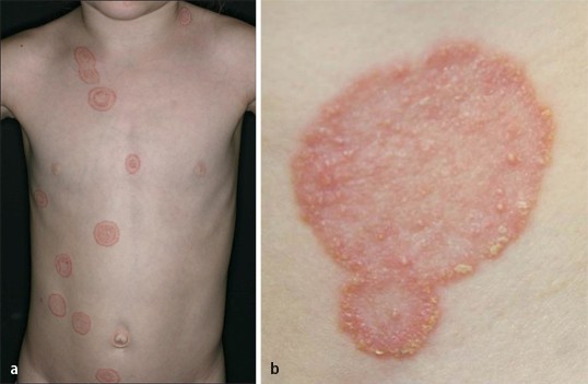 Lokale Kombinationstherapie bei entzündlichen Dermatomykosen | SpringerLink