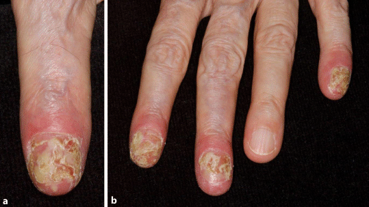 Pustulöse Psoriasis | SpringerLink