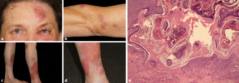 Disseminiertes nekrobiotisches Xanthogranulom | SpringerLink