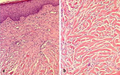 Hyperplastische Narben und Keloide | SpringerLink