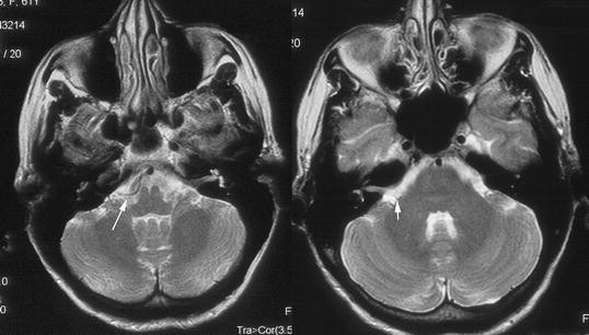 Vestibuläre Paroxysmie | SpringerLink