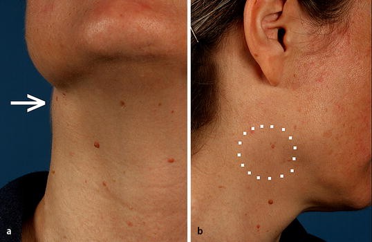 Schwellung der Halsweichteile | SpringerLink