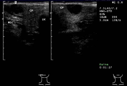Rezidivierendes und metastasierendes atypisches Fibroxanthom | SpringerLink