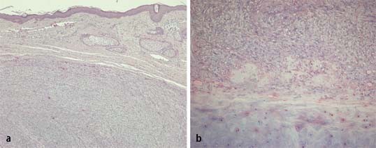 Rezidivierendes und metastasierendes atypisches Fibroxanthom | SpringerLink