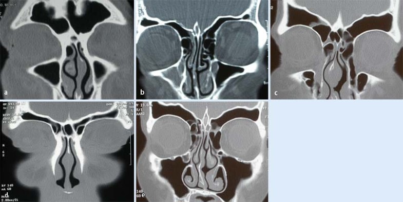 Die endonasale Chirurgie der Stirnhöhle | SpringerLink