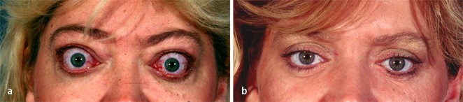 Endokrine Orbitopathie | SpringerLink