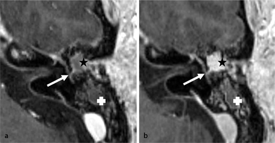 Computer- und Magnetresonanztomographie des N. facialis | SpringerLink