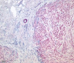 Leiomyom | SpringerLink