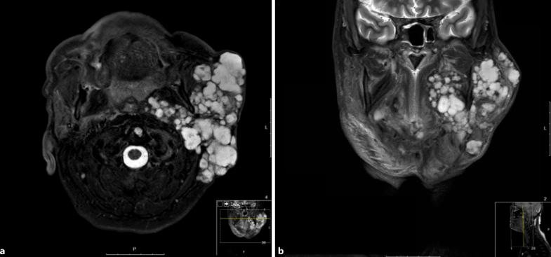 Schwellungen der Glandulae submandibularis und parotis | SpringerLink