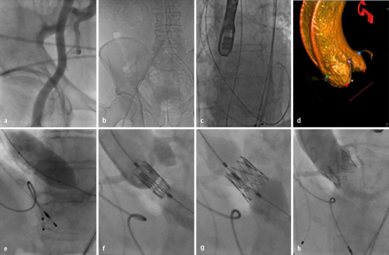 Transkatheteraortenklappenersatz (TAVI) | SpringerLink
