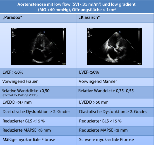 Paradoxe Low-flow-low-gradient-Aortenstenose | SpringerLink