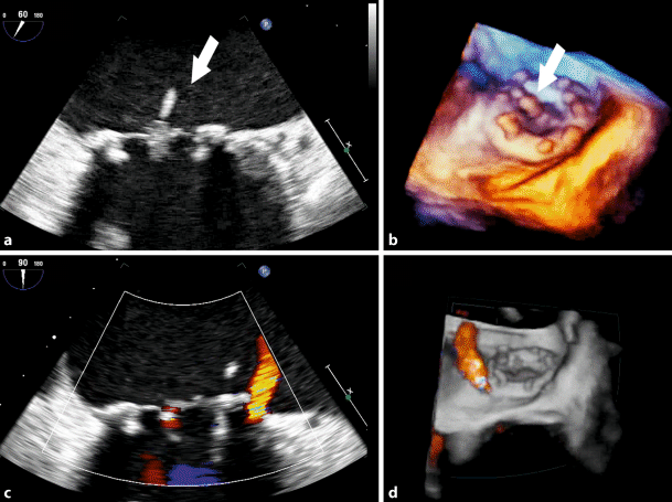 Infektiöse Endokarditis | SpringerLink