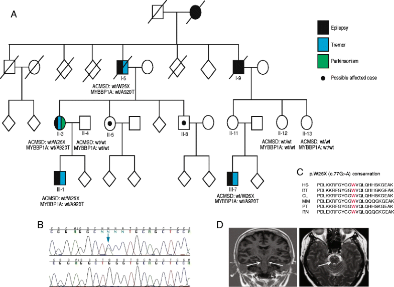 The ACMSD gene, involved in tryptophan metabolism, is mutated in a family with cortical ...
