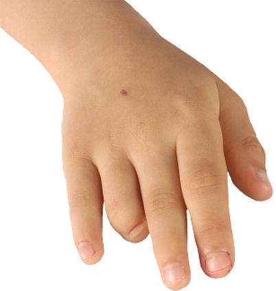 Fetales Alkoholsyndrom (FAS) | SpringerLink