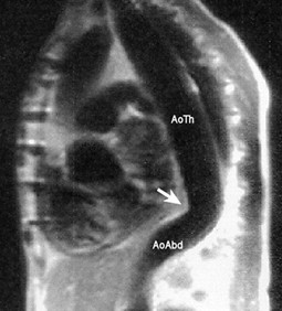Ektasie und Knickbildungen der Aorta, Hypertelorismus und Uvula bifida ...
